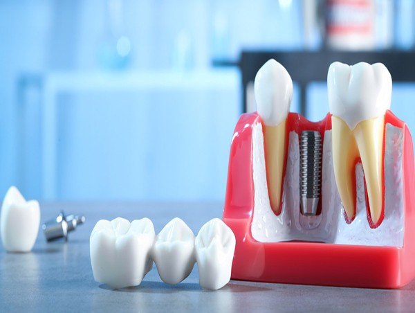 Single Tooth Implants and Dental Bridges Market Projected to Reach USD ...