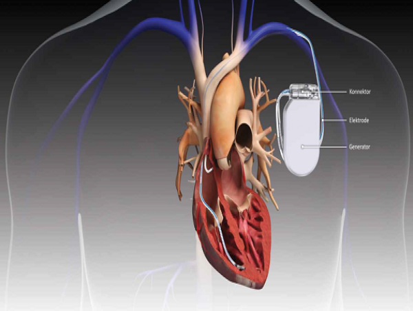 Implantable Medical Devices Market is set to Fly High Growth in Years ...