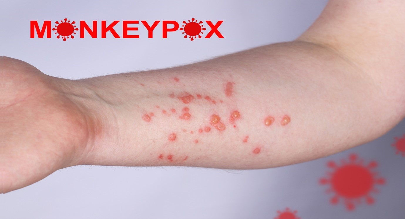 Monkeypox: Which is the worst hit country?